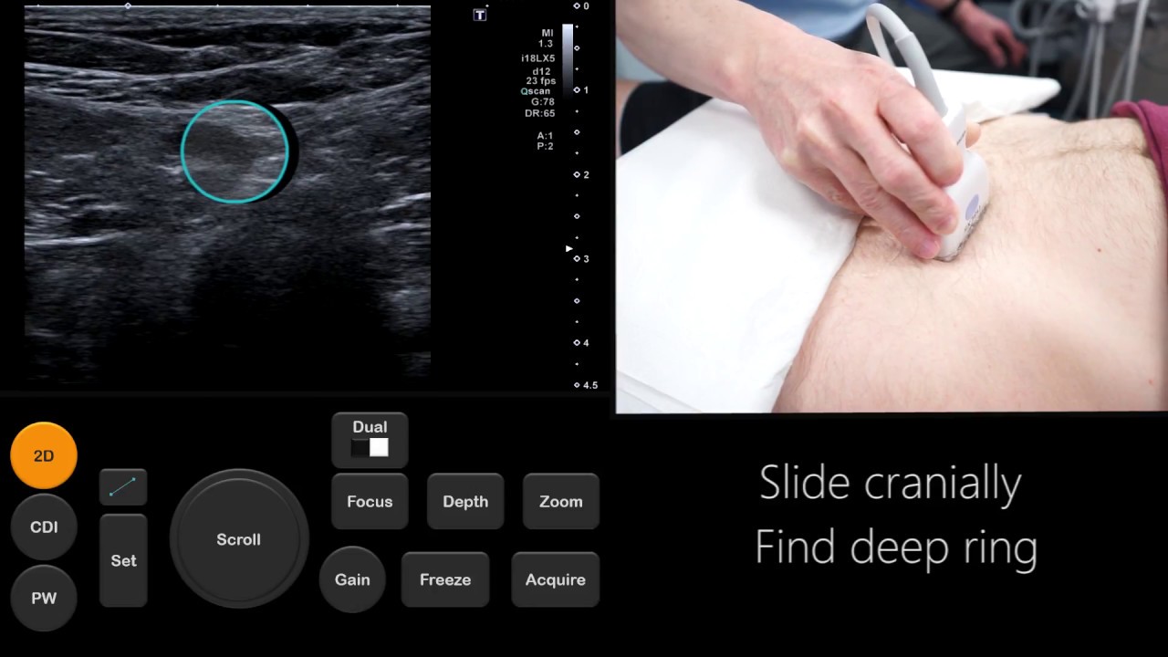 Ultrasound Tutorial Inguinal Femoral Hernia Assessment Radiology ultrasound-tutorial-inguinal-femoral-hernia-assessment-radiology