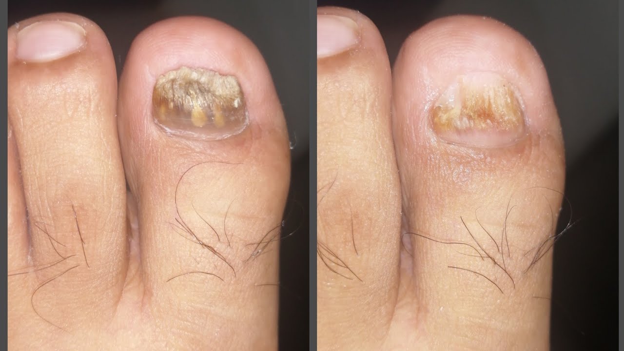 🍄Limpieza de uña con hongo (Onicomicosis) podología - YouTube