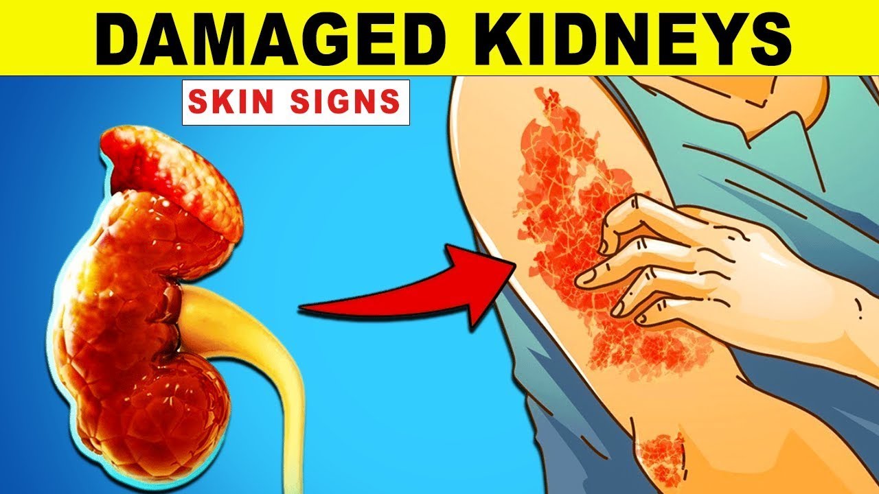 SHOCK! 9 Skin Signs That May Indicate Your Kidneys Are Damaged ...