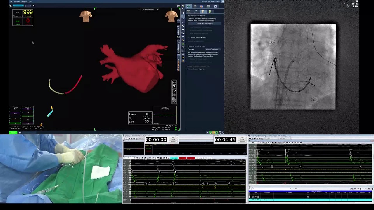AF Ablation/ #4 ICE exam and LA angiogram - YouTube