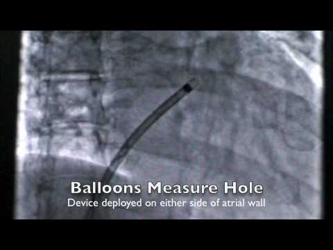 PFO Closure - YouTube