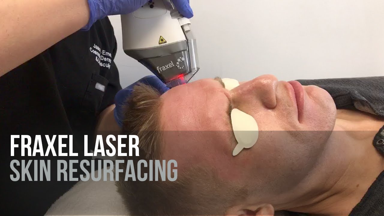Fraxel Laser Treatment for Skin Resurfacing | LIVE - YouTube