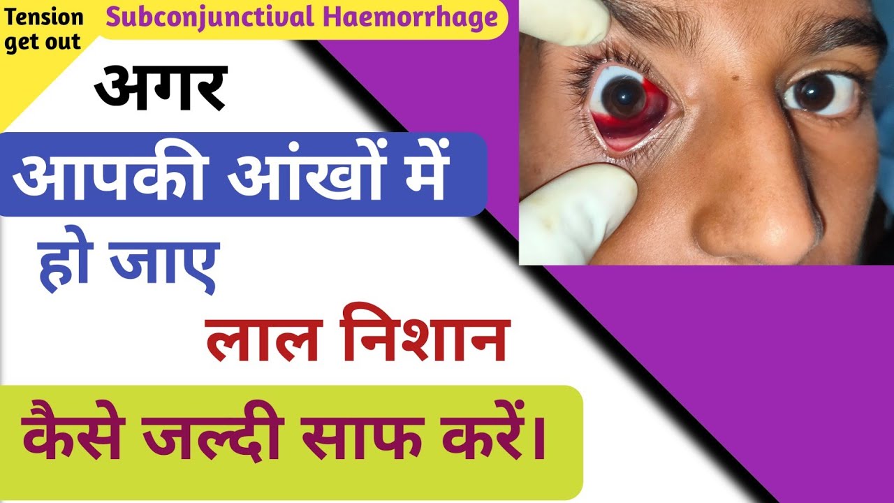 Red spot in eye| subconjunctival hemorrhage treatment| Tension get out ...