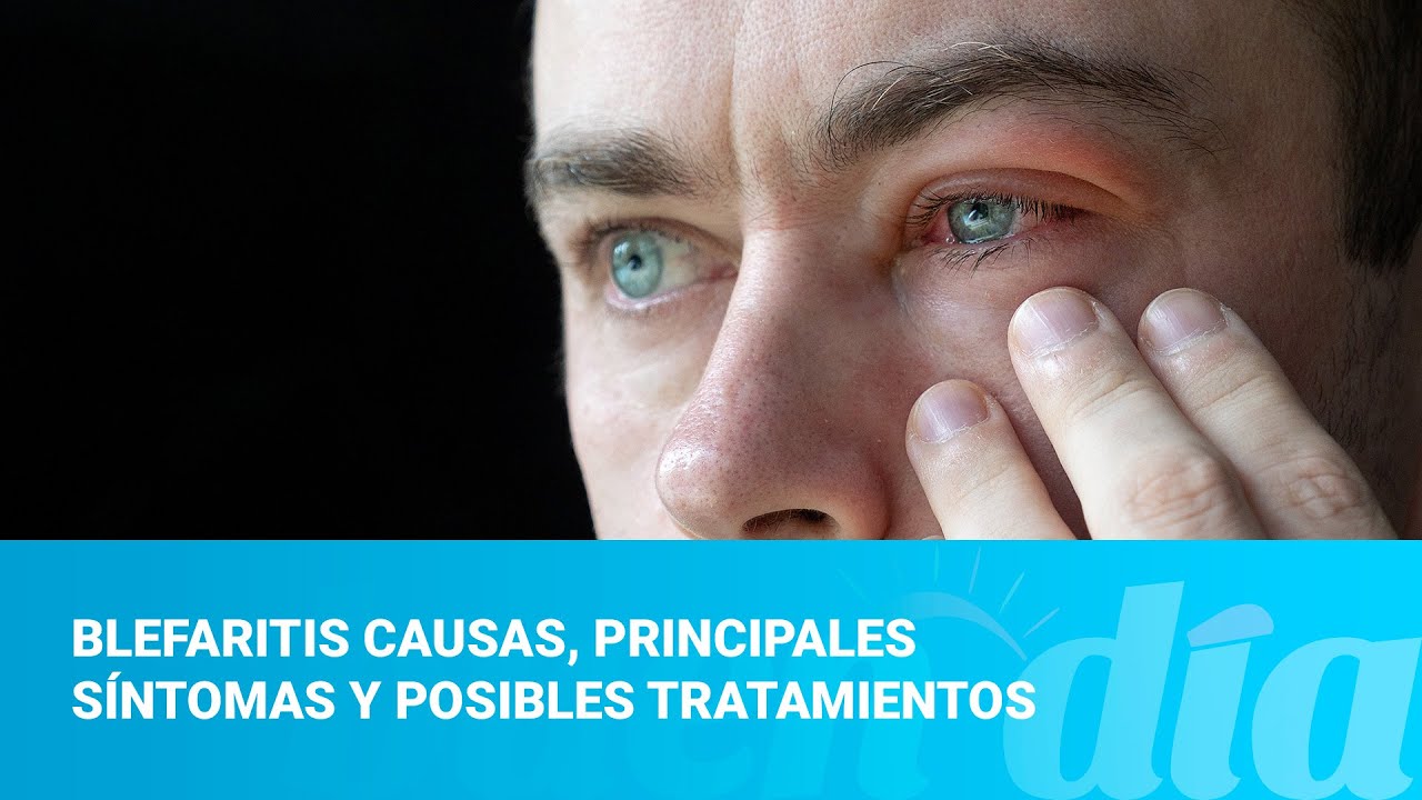 Blefaritis causas, principales síntomas y posibles tratamientos - YouTube