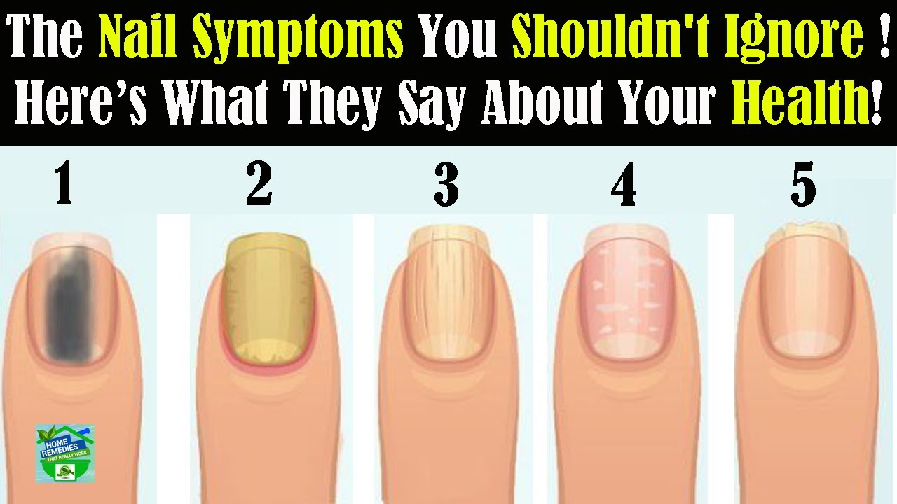 The Nail Symptoms You Shouldn't Ignore ! Here’s What They Say About ...