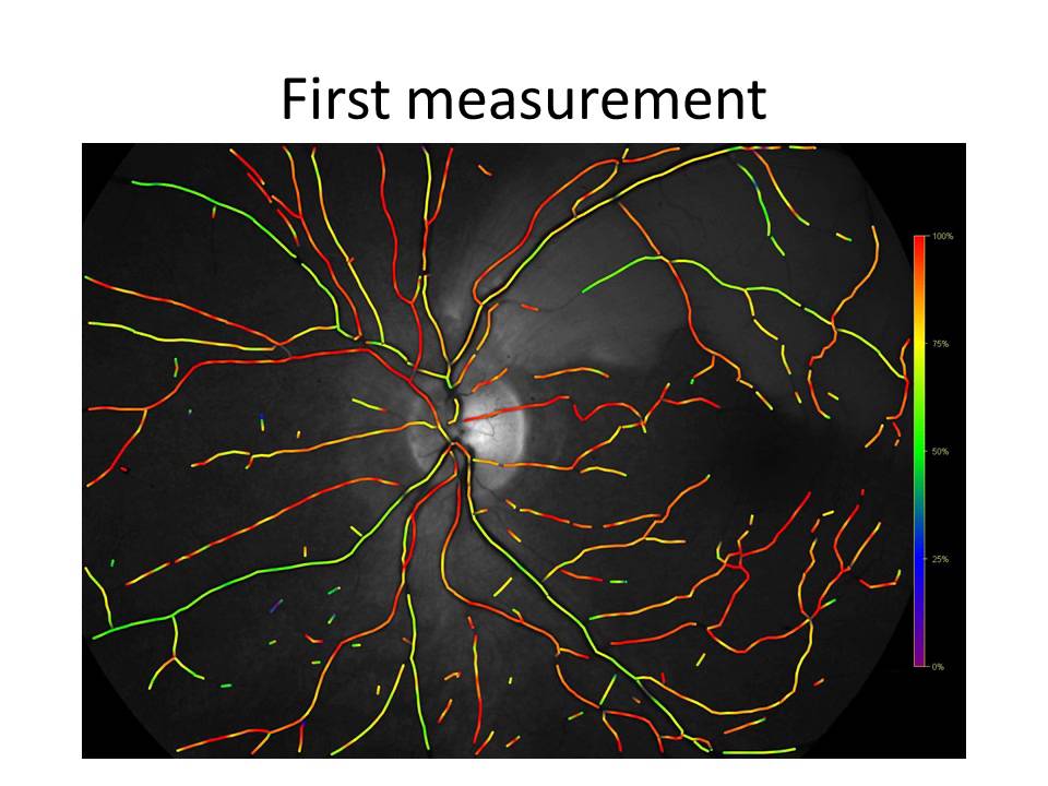 Clinical use of oximetry in severe retinal hypoxia [Sveinn Hardarson ...