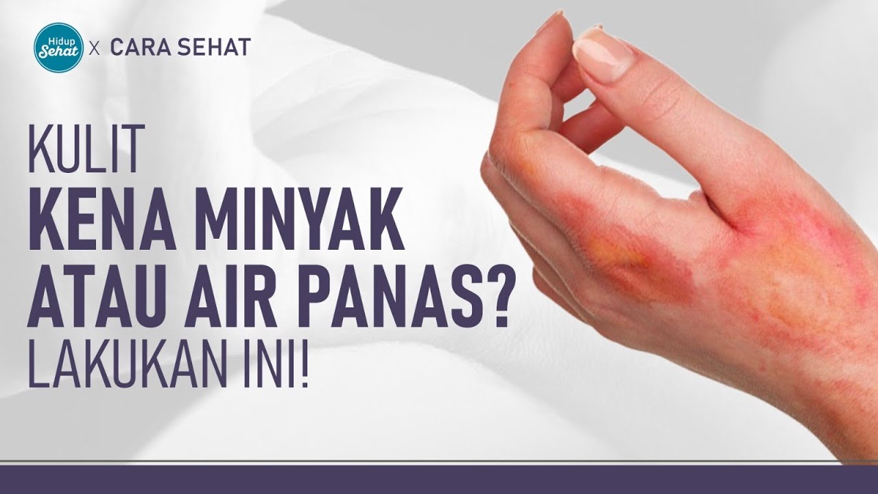 Kulit Terkena Minyak atau Air Panas? Ini Yang Harus Dilakukan! | Hidup ...