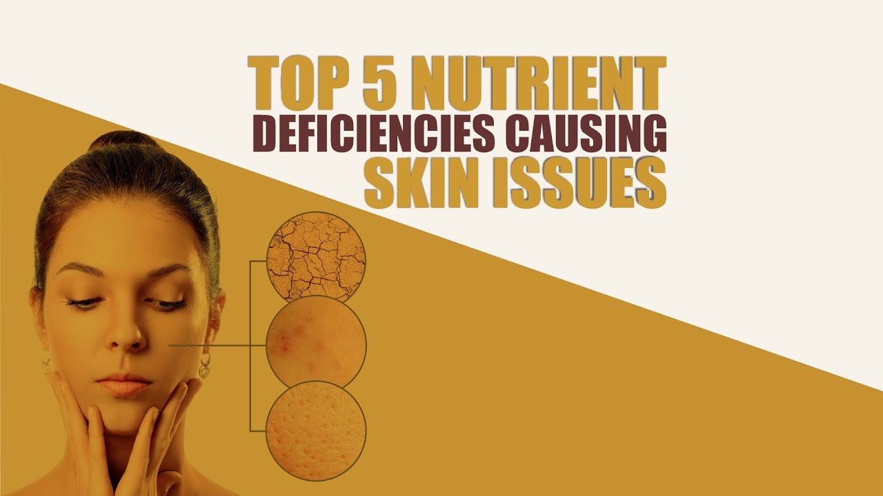 Top 5 Nutrient Deficiencies Causing Skin Issues | Shivangi Desai - YouTube