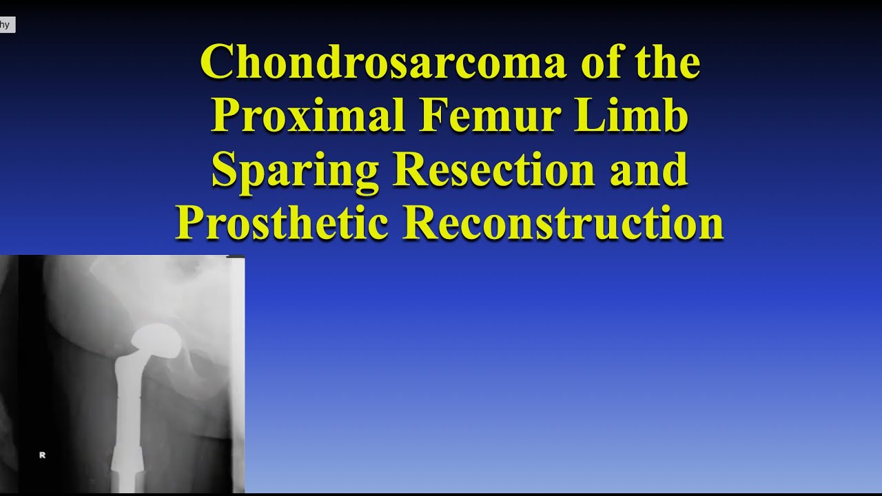 Chondrosarcoma of the Proximal Femur Limb Sparing Resection and ...