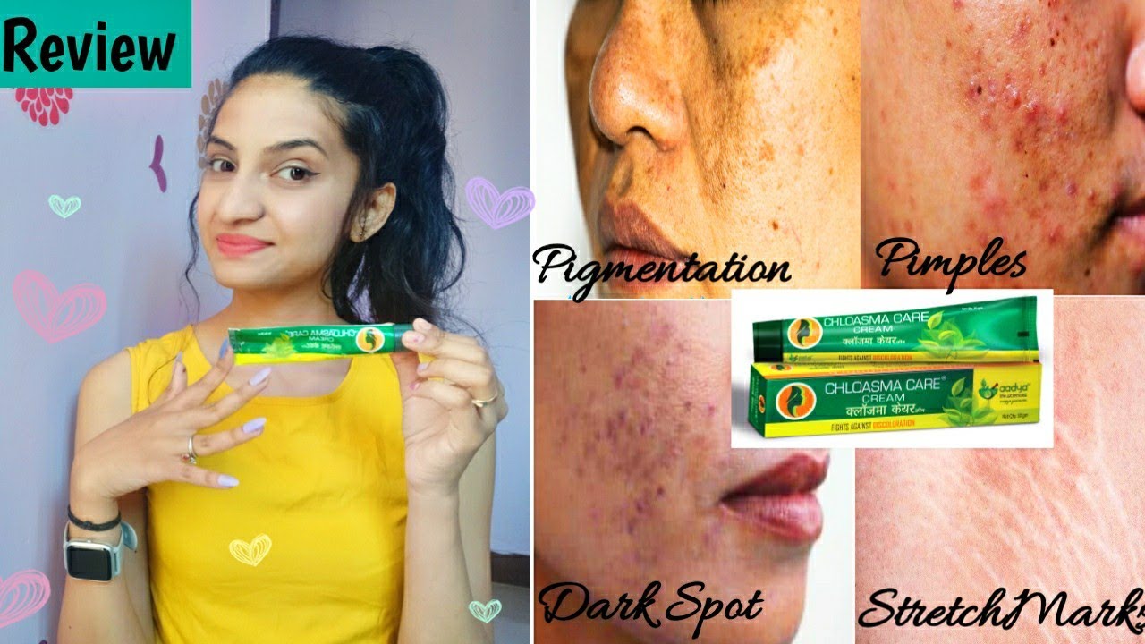 Choasma Care Cream For HyperPigmentation, Pimples, Blemishes, Stretch ...