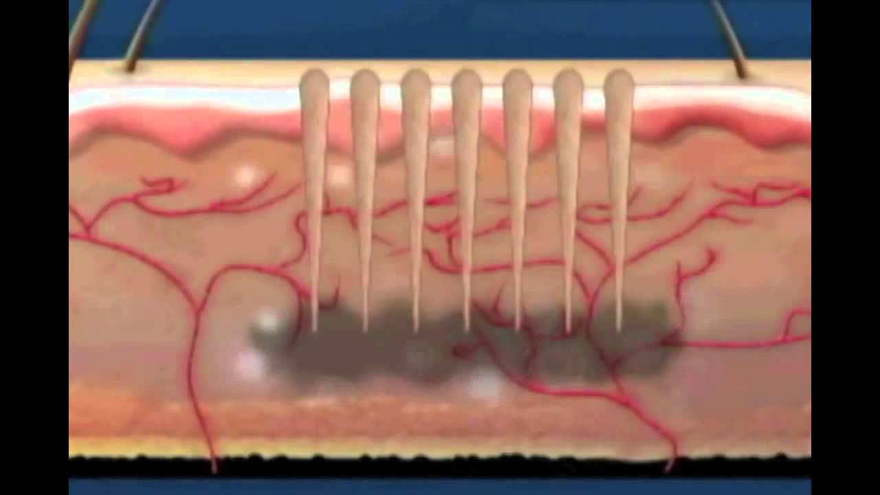 GENOSYS beauty roller, why skin microneedling www genosys usa com - YouTube