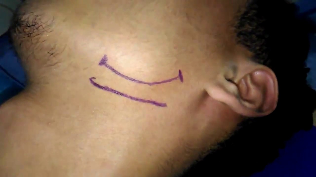 Voie Risdon modifiée / Dr Zaroual / Chirurgie Esthétique et maxillo ...