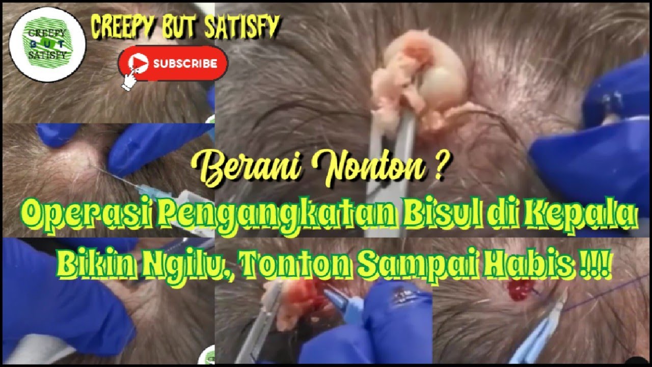 Operasi Pengangkatan Bisul di Kepala Bikin Ngilu‼️ - YouTube