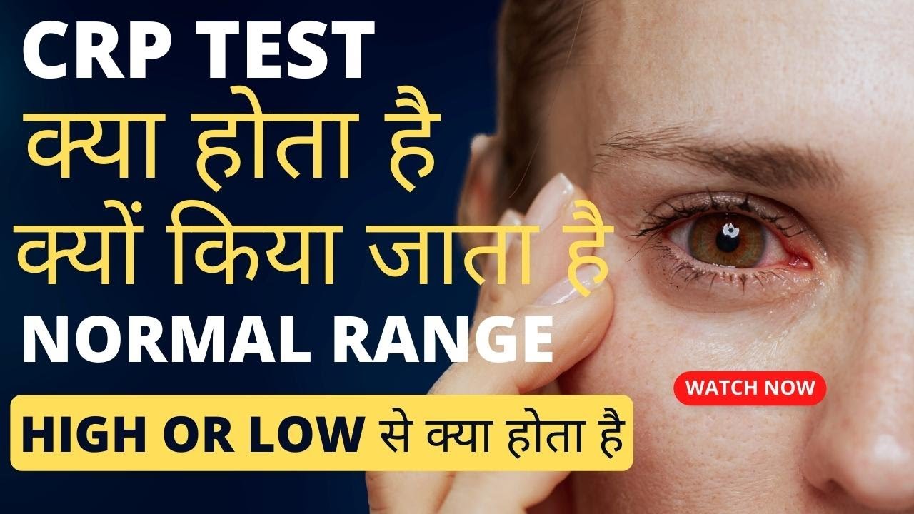 CRP Test Kya Hota Hai Crp Test In Hindi Crp Test Normal Range Crp crp-test-kya-hota-hai-crp-test-in-hindi-crp-test-normal-range-crp