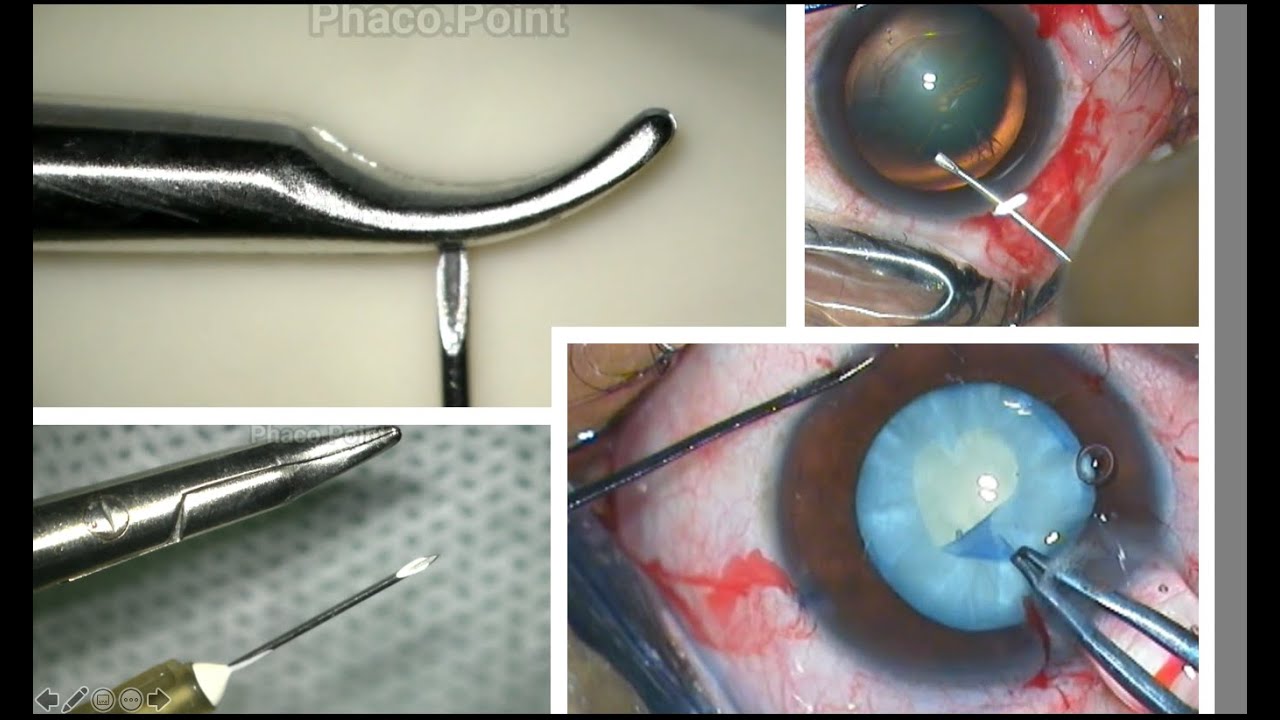 The Beginner's guide to success in cystitome creation and to achieve ...