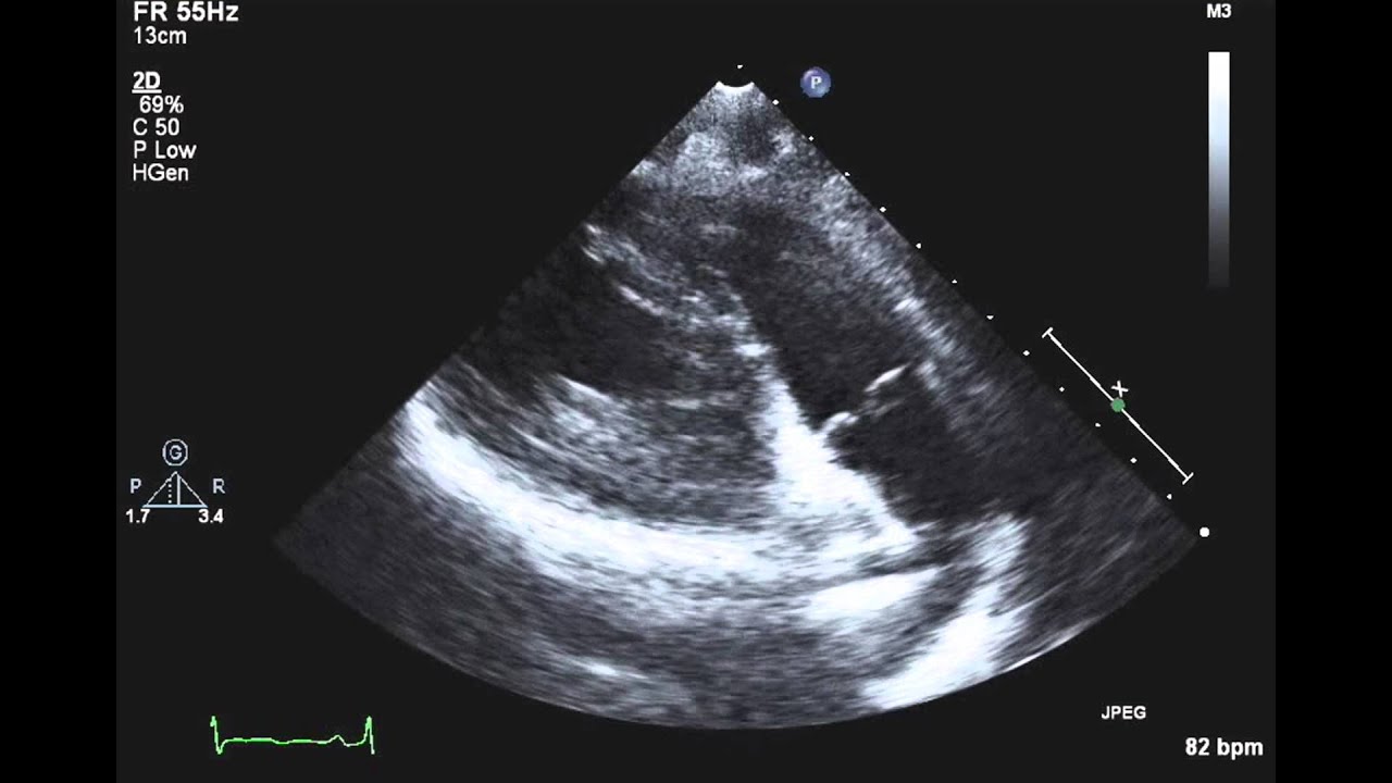 TTE Normal PLAX RV outflow Example 2 - YouTube