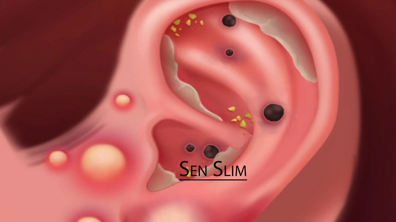 Ear acne removal and Removal Blackhead for gamer | Happy Hospital - YouTube