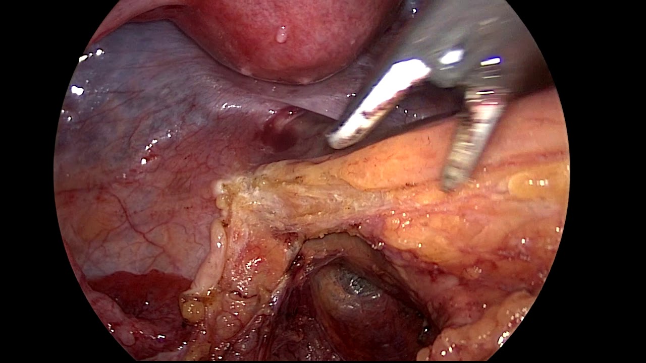 Completion Proctocolectomy - Jpouch - YouTube