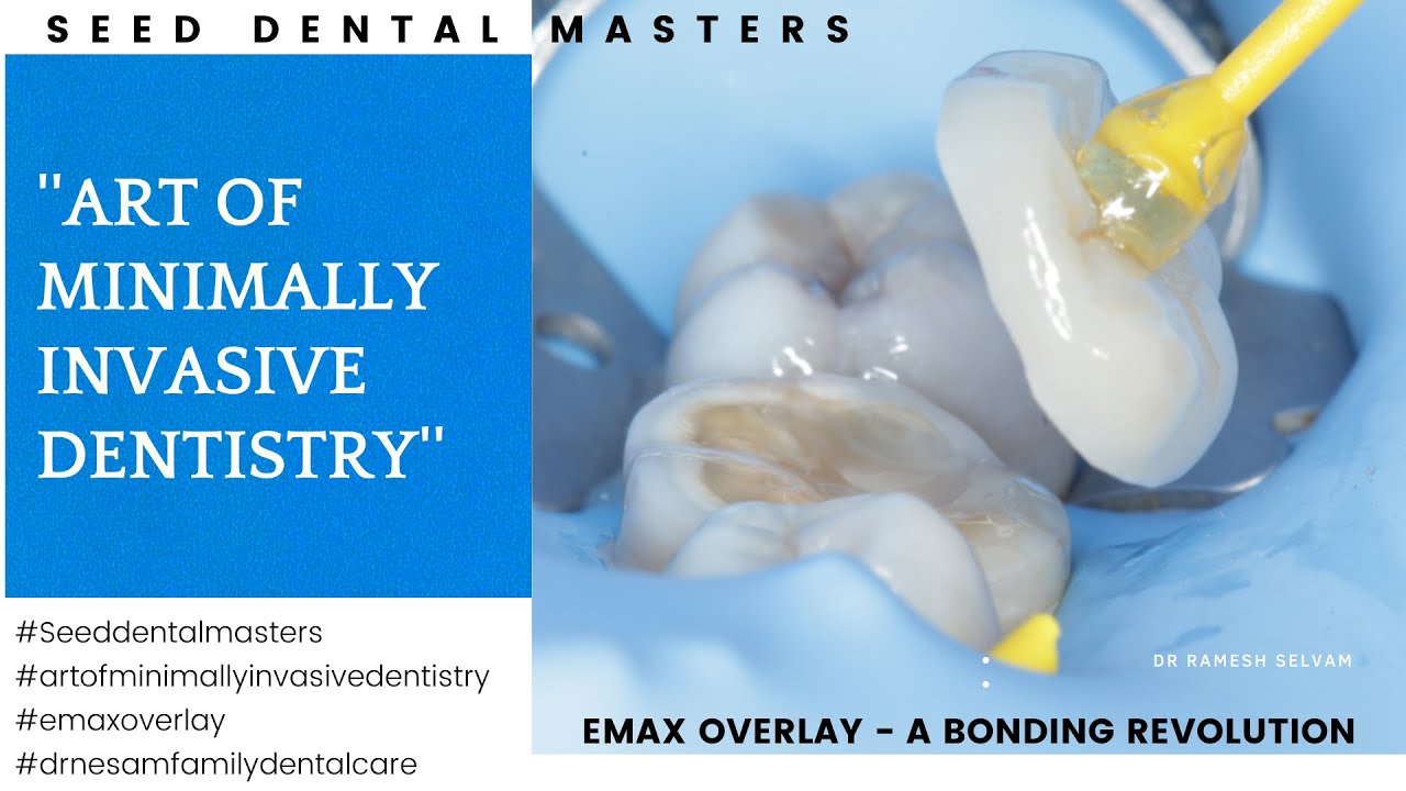SEED DENTAL MASTERS -ART OF MINIMALLY INVASIVE DENTISTRY - EMAX OVERLAY ...