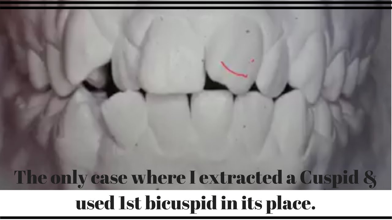The only case where I extracted a Cuspid & used 1st bicuspid in its ...