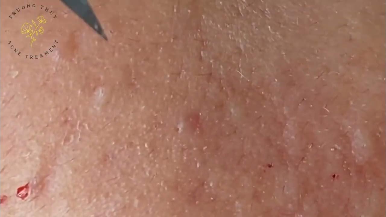 Top Satisfying Relaxing With Best Video Sac Dep Beauty Acne Spa 9 Youtube