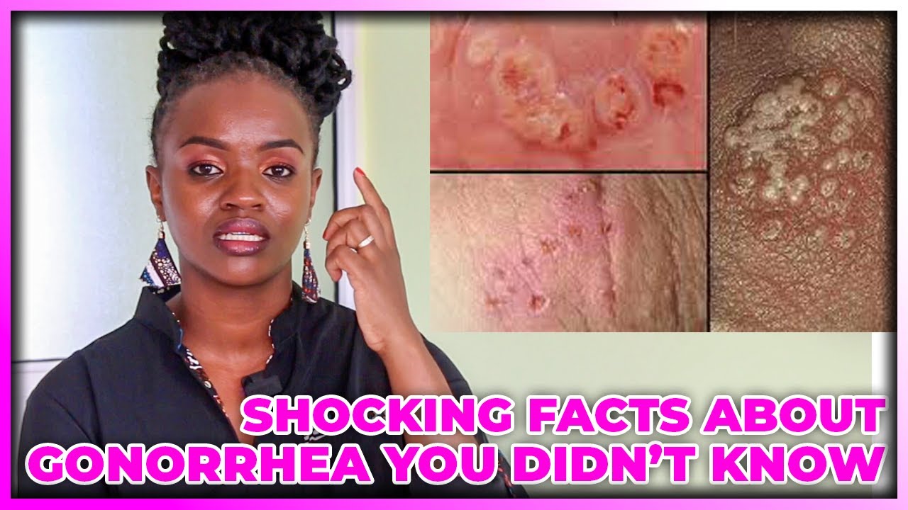 Expert Guide on the Causes, Symptoms and Treatment of Gonorrhea - YouTube