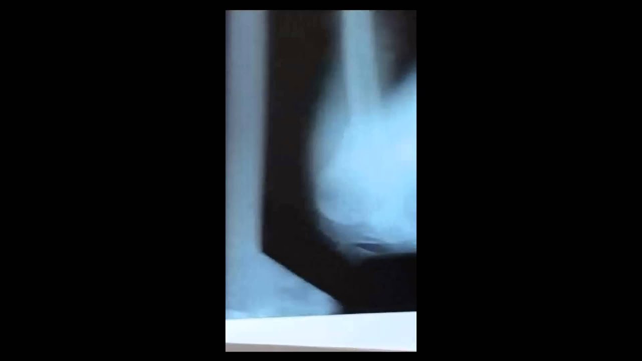 Practical Forensic -X-ray - Part 3 - YouTube