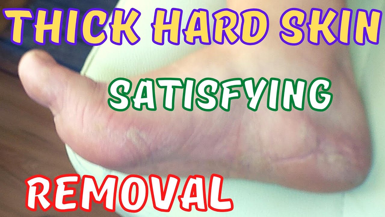 Thick hard skin removal. Cracked heels treatment. - YouTube