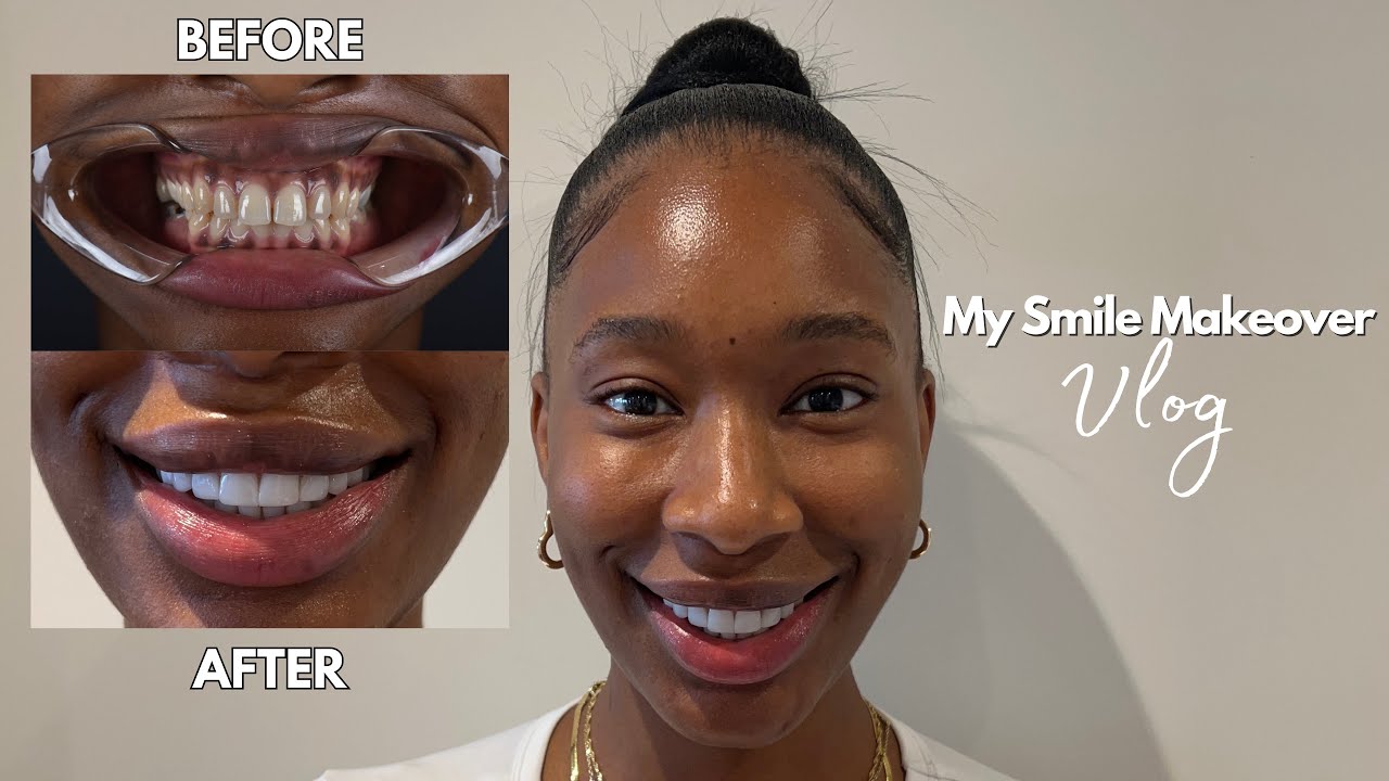 I GOT MY TEETH DONE IN TURKEY WITH MINIMAL SHAVING | The Process | Cost ...