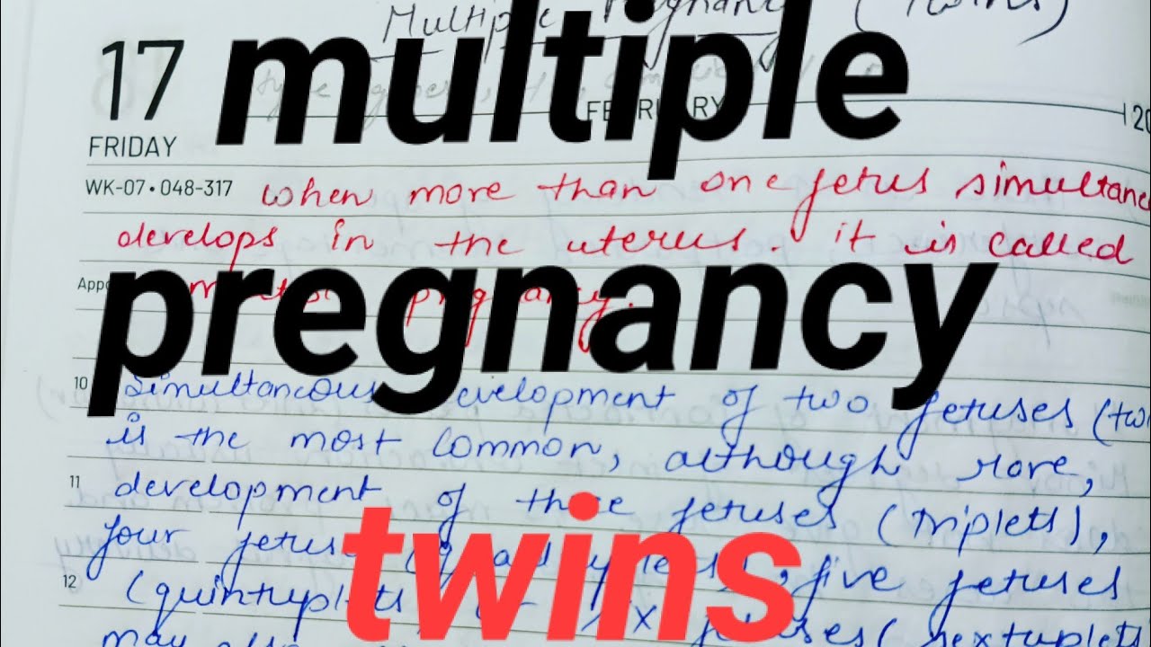 multiple pregnancy,obstetrics topic,well explanation by handwritten ...