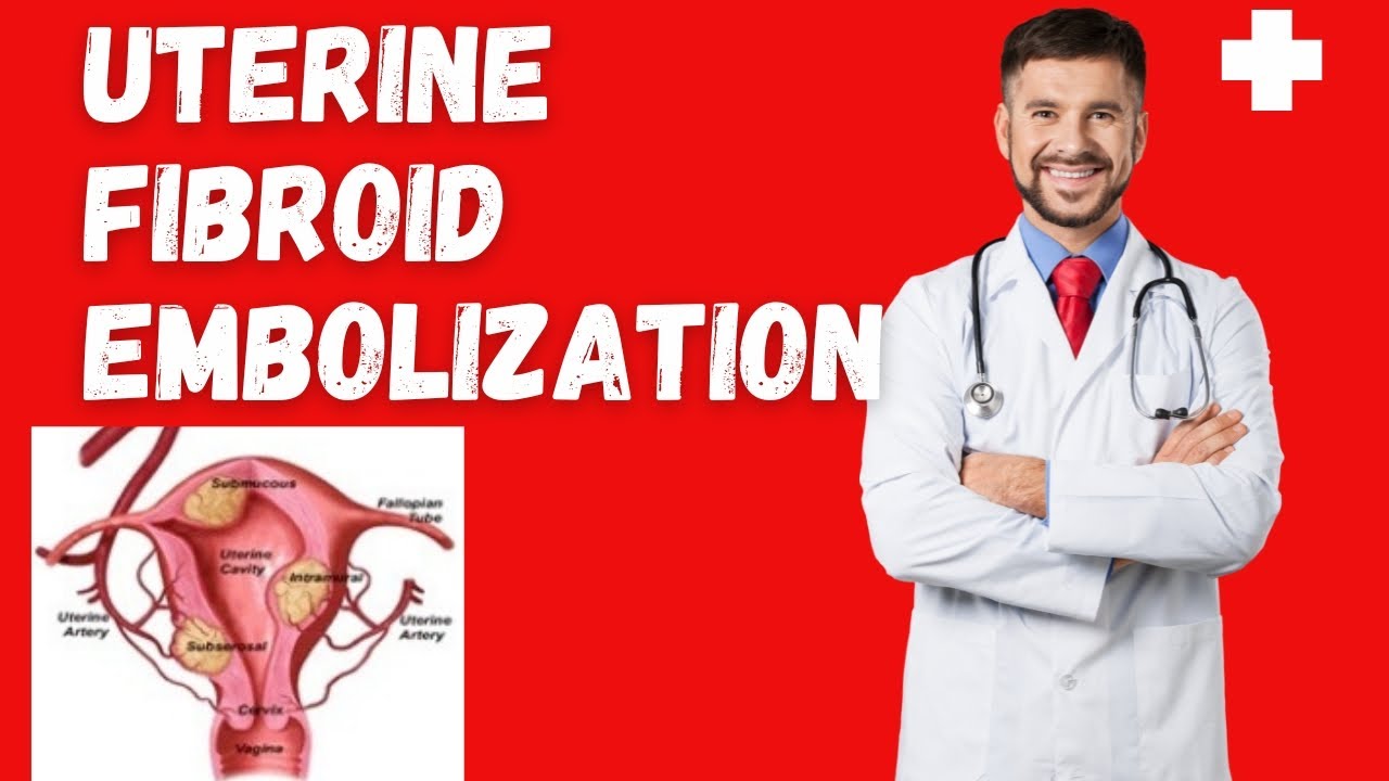 UTERINE FIBROID EMBOLIZATION - YouTube