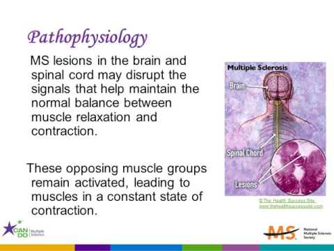 Understanding and Managing Your Spasticity - YouTube