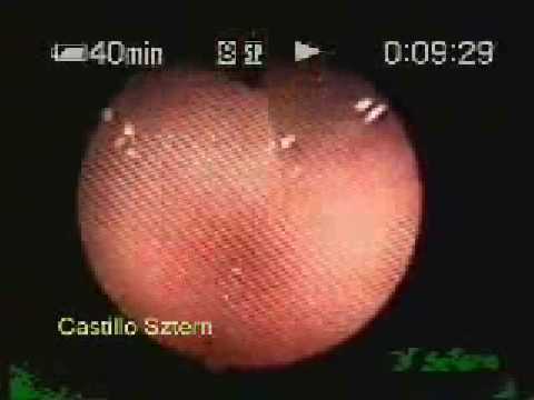 Edema de Reinke (Cuerdas Vocales) - YouTube