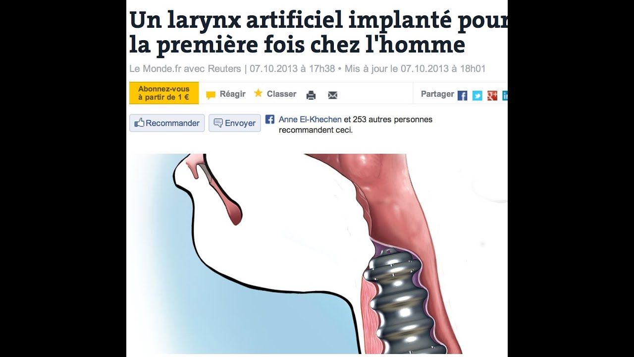 LARYNX ARTIFICIEL CHU STRASBOURG ORL - YouTube