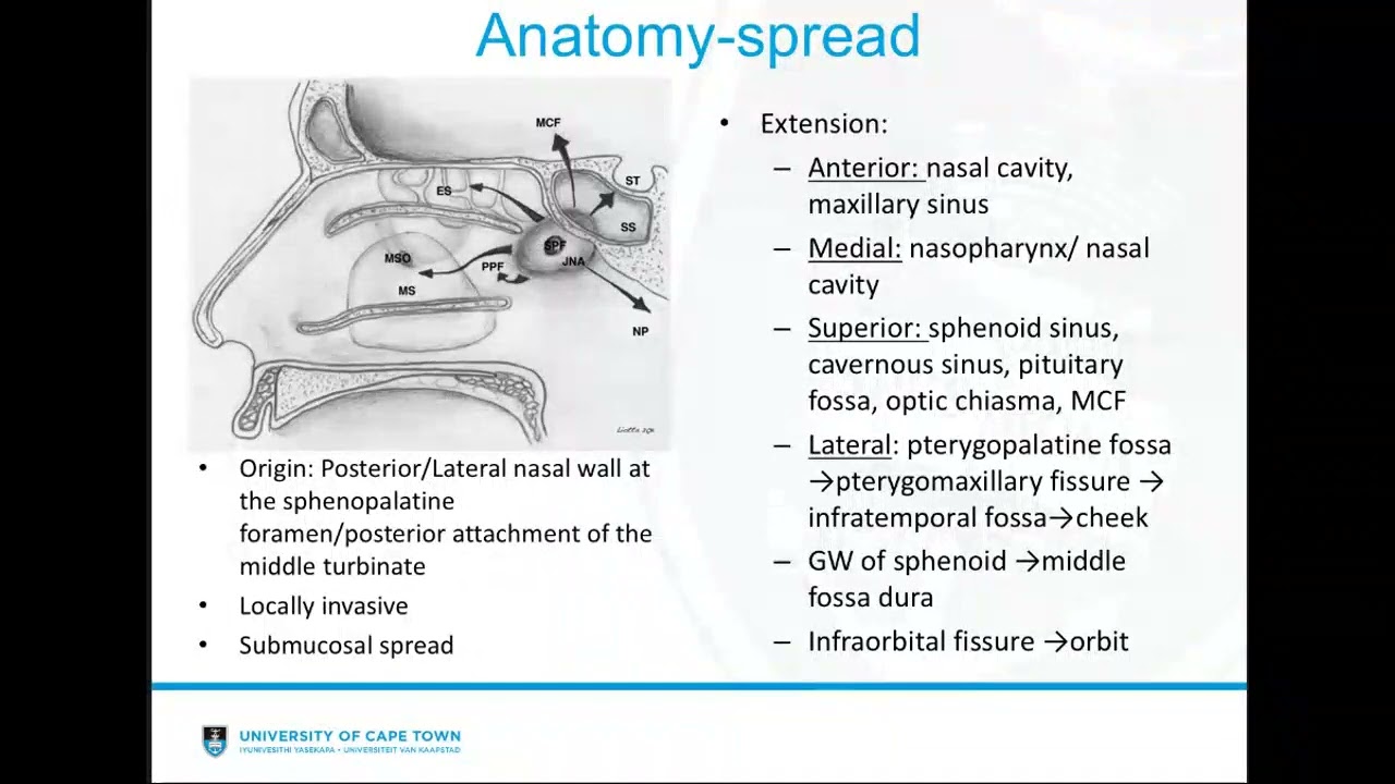 Nasopharyngeal Angiofibroma Juvenile Nasopharyngeal Angiofibroma (JNA)