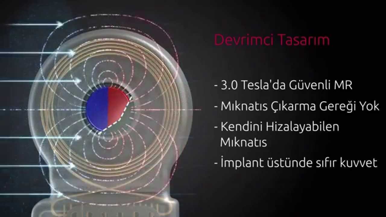 SYNCHRONY Koklear İmplant - YouTube