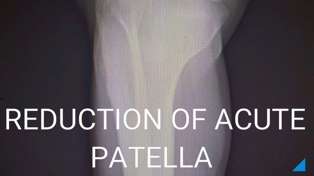REDUCTION OF ACUTE PATELLA DISLOCATION - YouTube