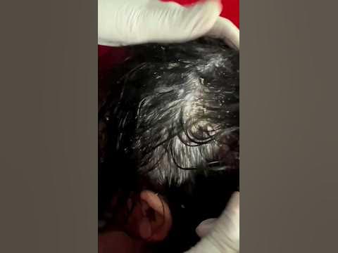 ketombe parah di rambut yang basah - YouTube