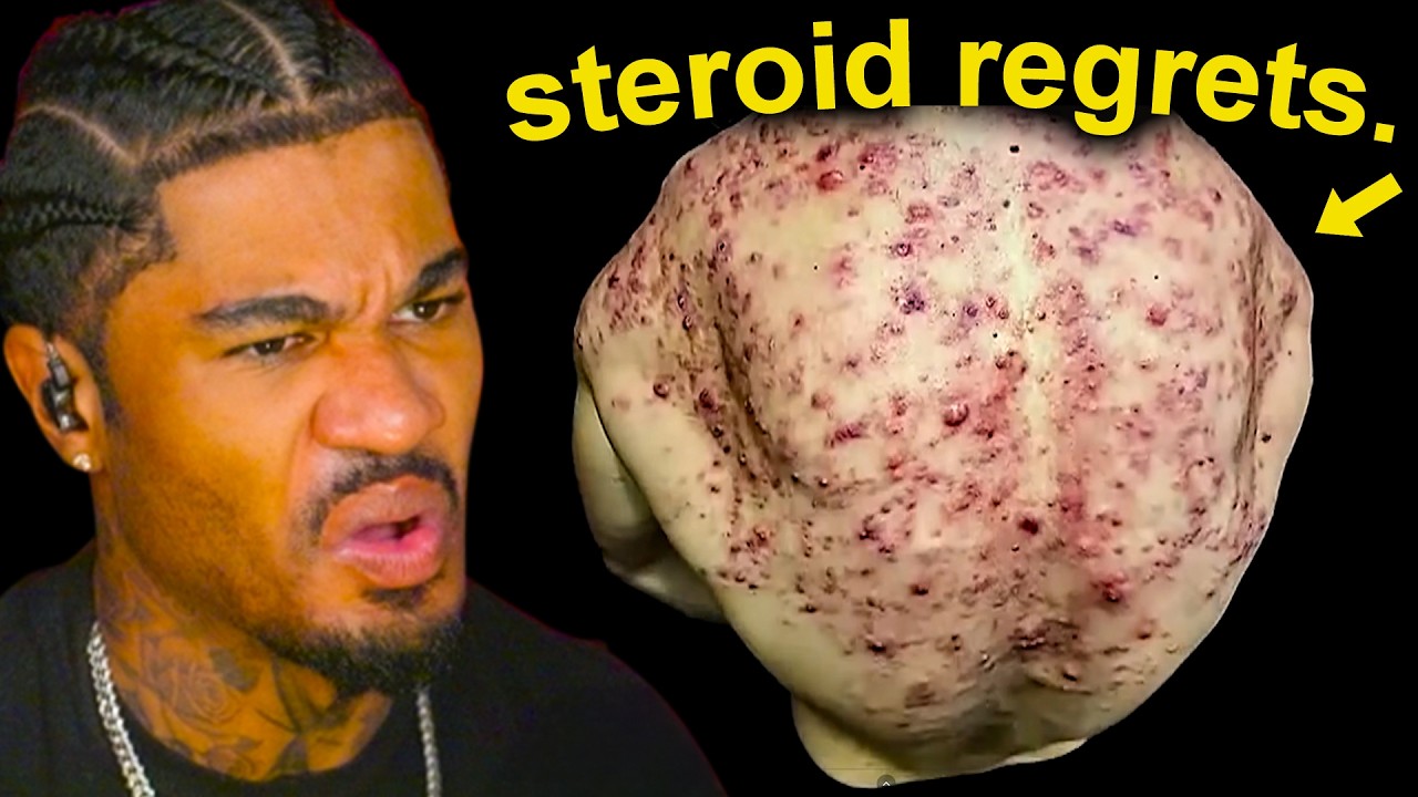 The Worst Steroid Acne You’ll Ever See .. - YouTube