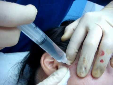 Prolotherapy TMJ by a Musculoskeletal Physician肌骼科醫生示範顳下頜關節的保絡治療 - YouTube