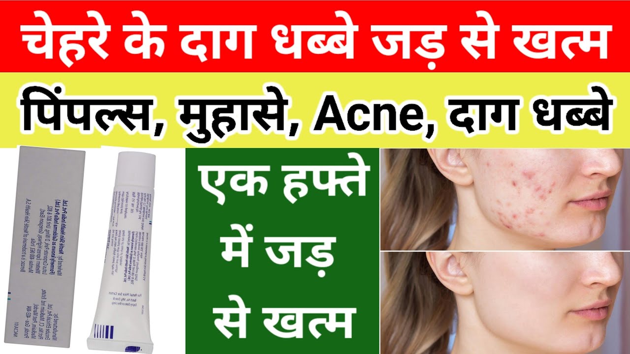 एक हफ्ते में चेहरे के दाग धब्बे जड़ से खत्म/face par pimple daag dhabbe ...