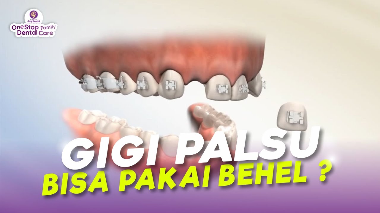 GIGI PALSU BISA DIPASANG BEHEL ? YUK KITA CARI TAHU JAWABANNYA - YouTube