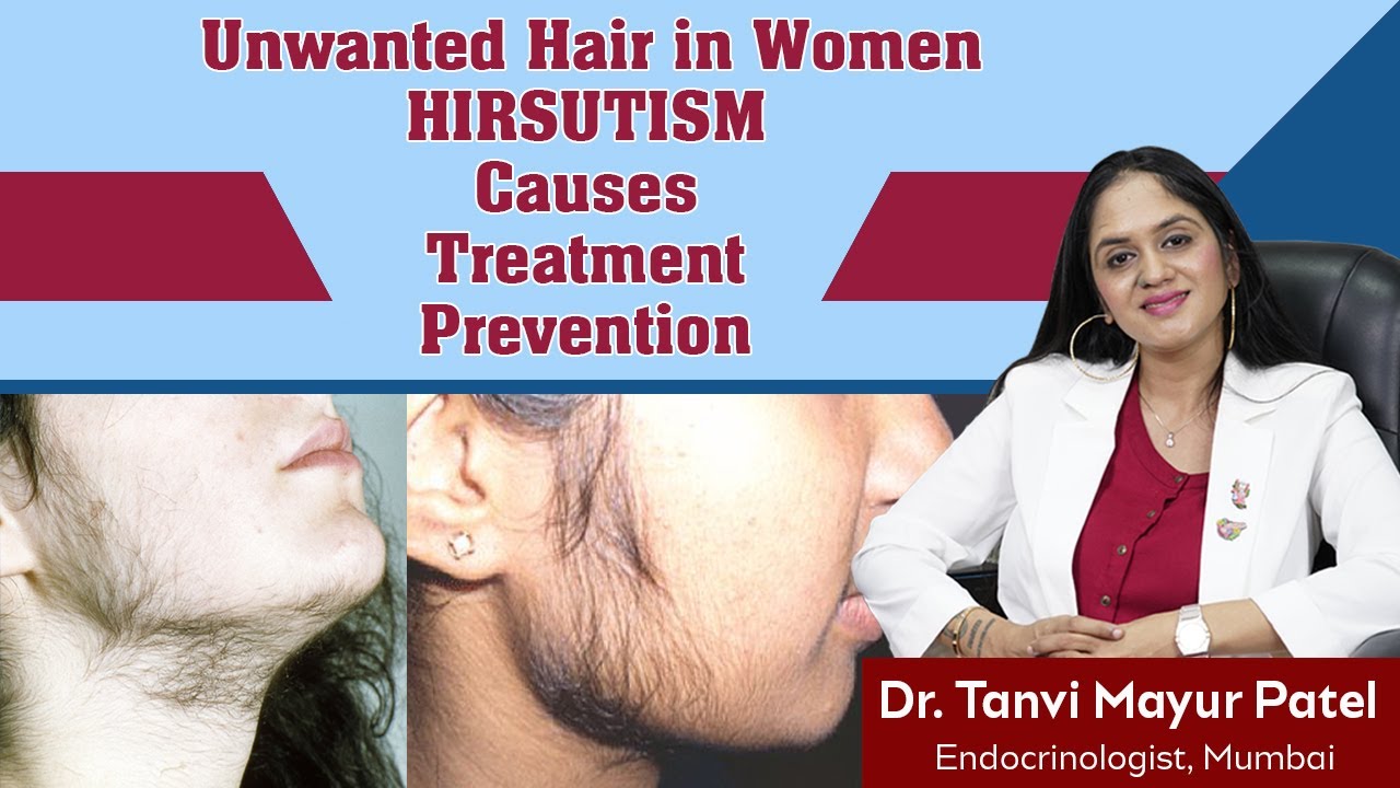Hirsutism Treatment