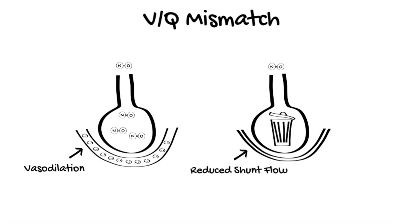 Inhaled Nitric Oxide in ICU - YouTube