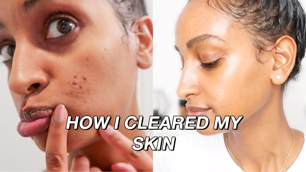SKIN CARE ROUTINE + CLEAR SKIN TIPS | WHAT YOU NEED TO HELP CLEAR YOUR ...