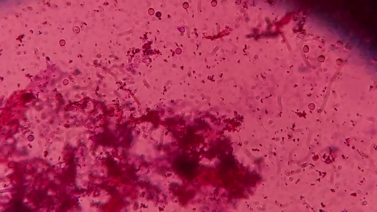 Sedimen Urine Dengan Pewarnaan - YouTube