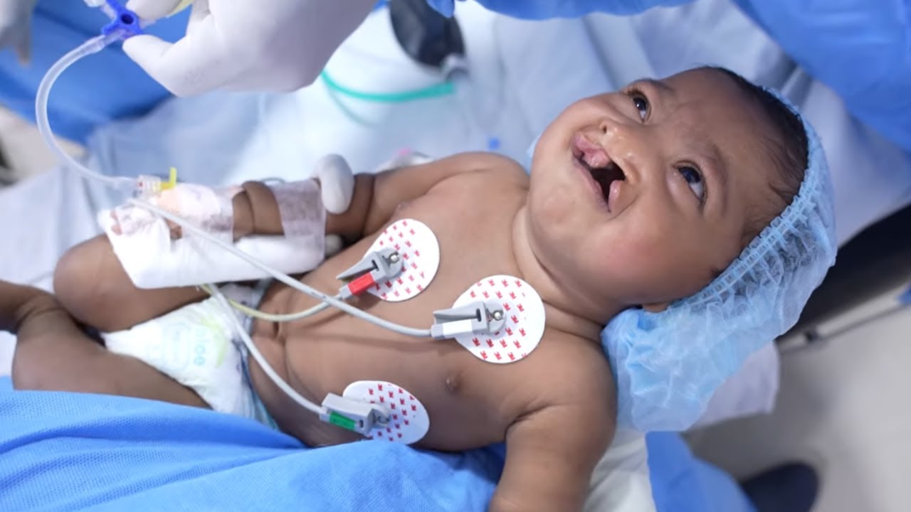 5 Months Baby Going into Anesthesia for Cleft Lip Surgery - YouTube
