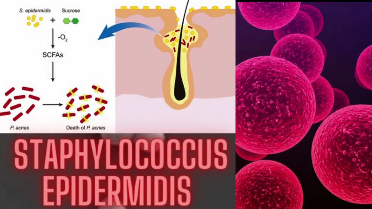 staphylococcus epidermidis (S. epidermidis ) ||Easy Microbiology - YouTube