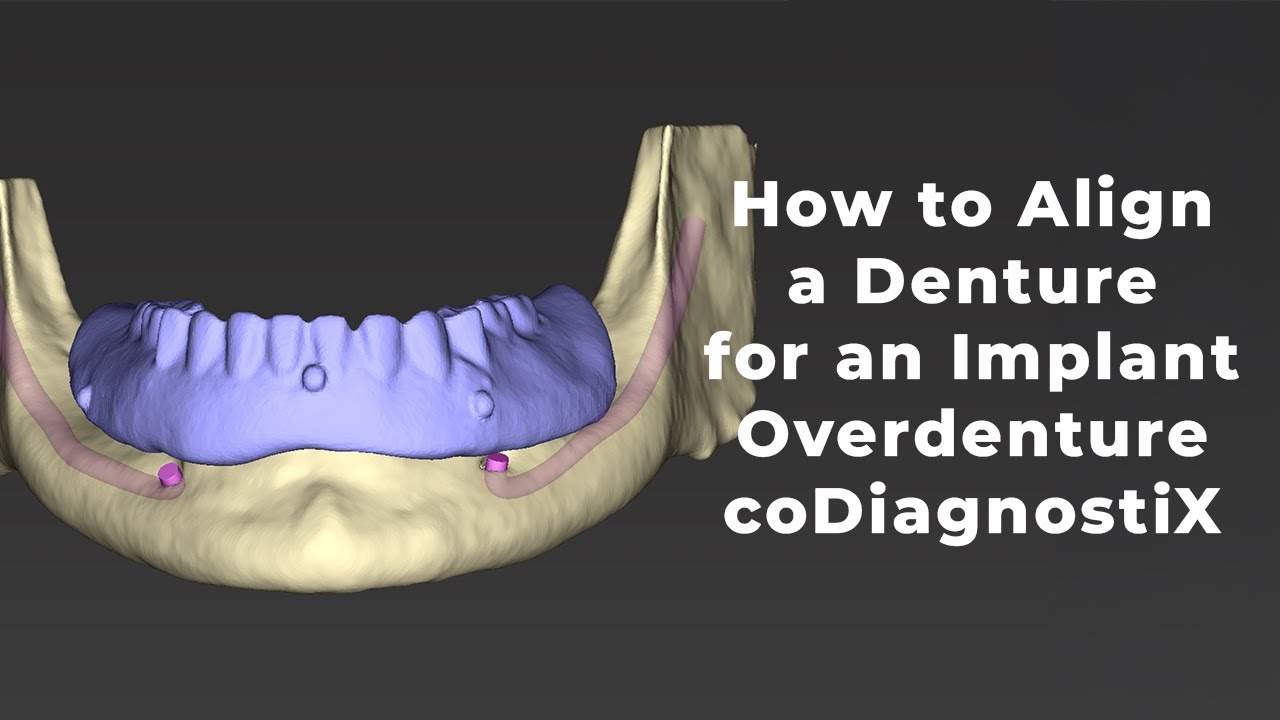 Aligning a Denture to CBCT for Implant Overdenture Planning ...