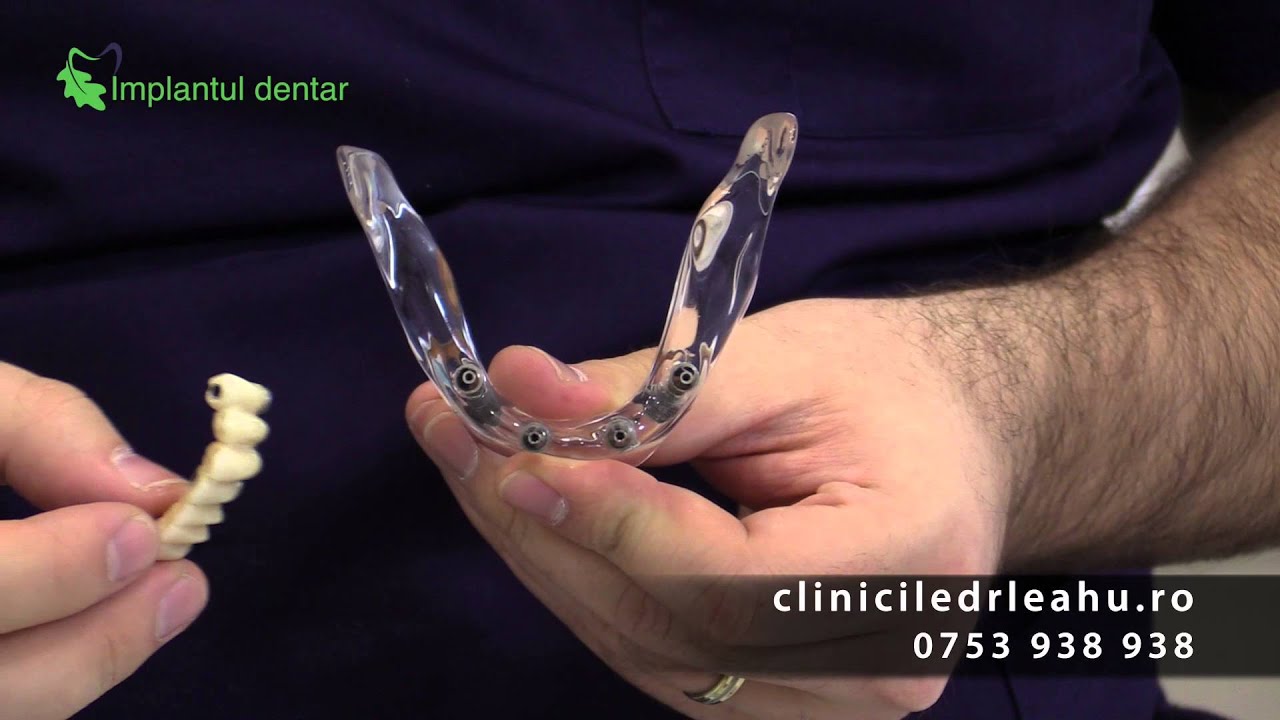Dr. Ionut Leahu - Ce este si cat costa un implant dentar - YouTube